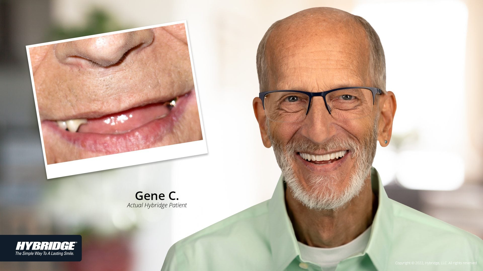 Hybrid Dentures Revolutionary Tooth Replacement